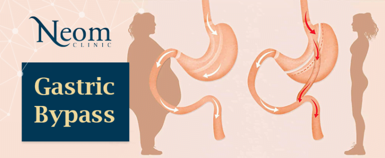 Lose Weight and Improve Your Health: The Benefits of Gastric Bypass ...